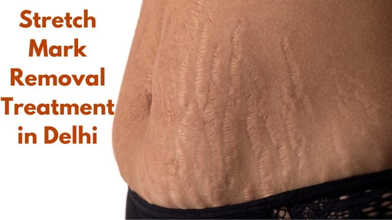 Stretch Mark Removal Treatment in Delhi | cost of mark removal