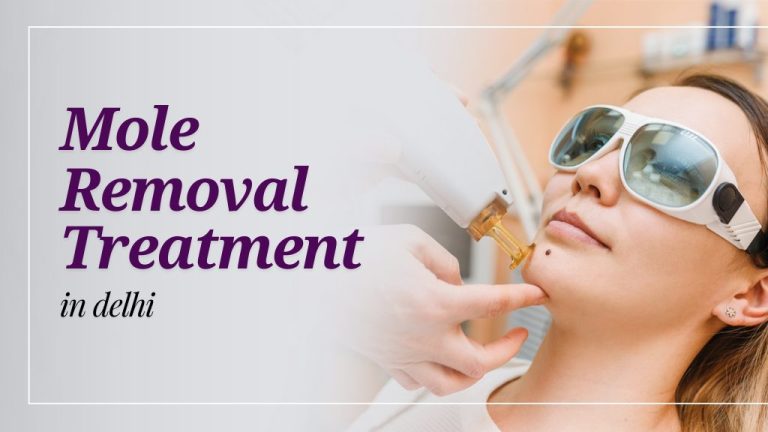 Choosing the Right Mole Removal Treatment in Delhi