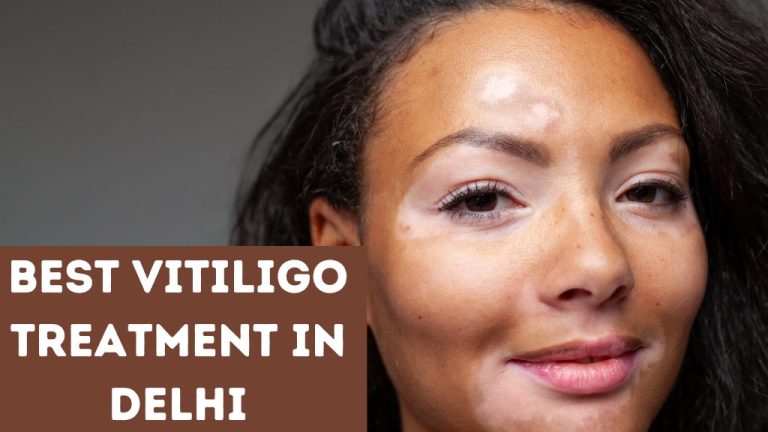Best Vitiligo Treatment in Delhi | Cost and Vitiligo Specialist